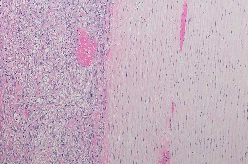 Sarcomatoid Mesothelioma: Get Diagnosed & Treated