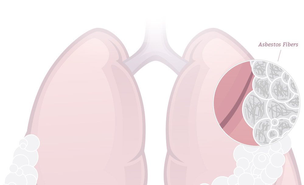 Malignant Pleural Mesothelioma Cancer Information